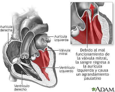 Cirugía Valvular Mitral Clínica Cardiovascular Dr Valderrama